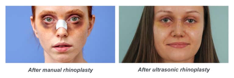 Ultrasonic Rhinoplasty: Revolutionizing Nasal Reshaping with Precision ...