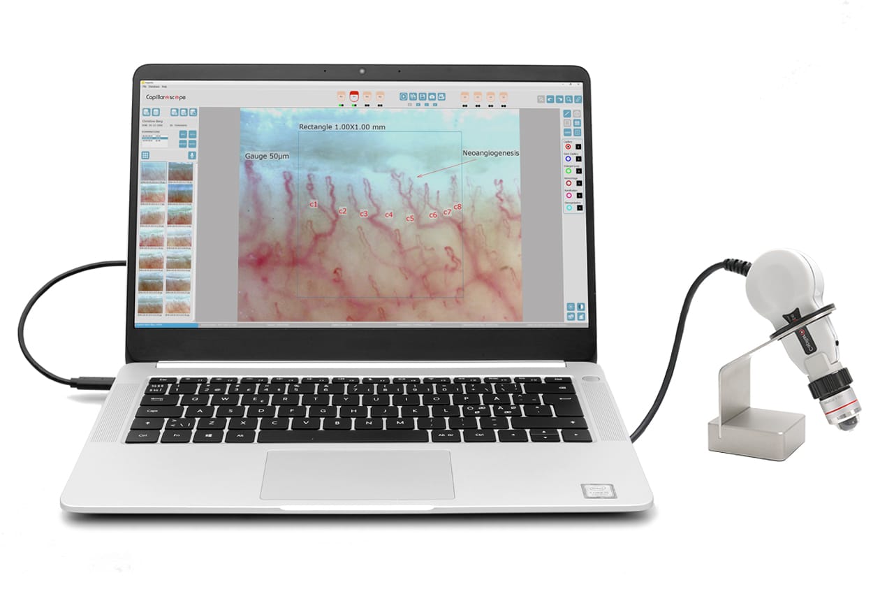 Inspectis Expand Possibilities of Capillaroscopy Examination ...