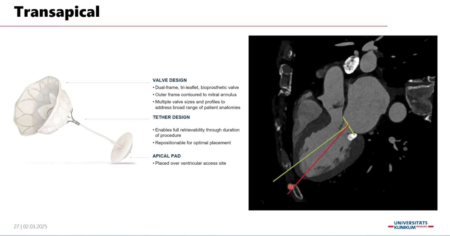 Measuring the Heart: A Radiologist with a Ruler - MedicalExpo e-Magazine