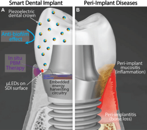 IDS: Smart Dental Implants to Revolutionize Oral Health - MedicalExpo e ...
