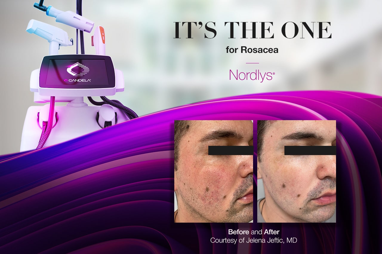 Nordlys® Advances in Rosacea - MedicalExpo e-Magazine
