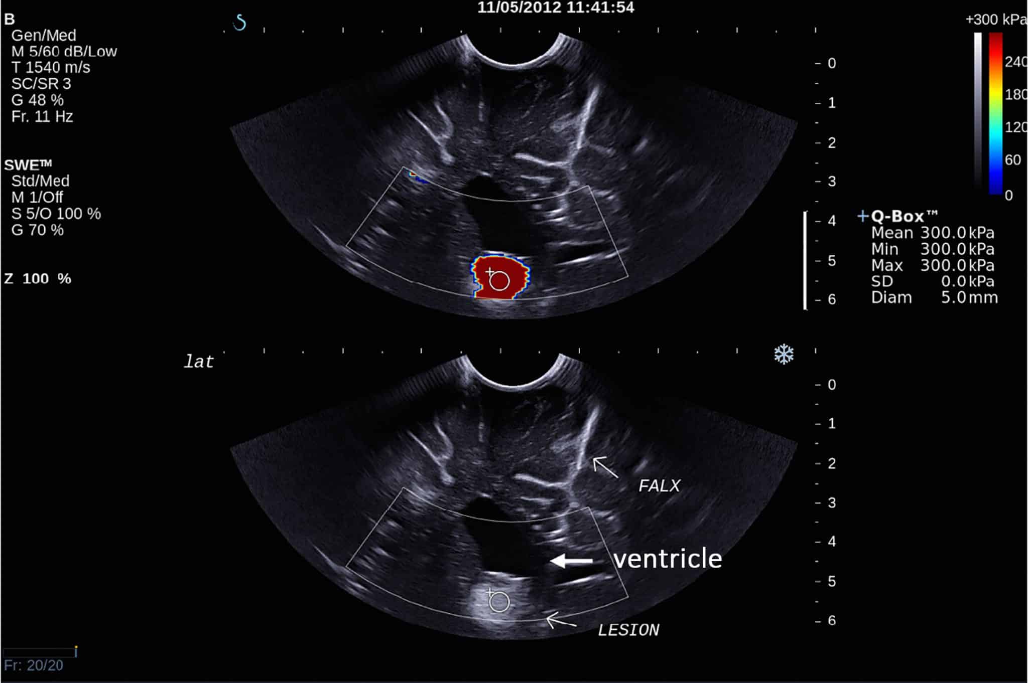 Ultrasound Scan Detects Cancer Tissue Left Behind After Brain Tumor ... Ultrasound Scan Detects Cancer Tissue Left Behind After Brain Tumor ...