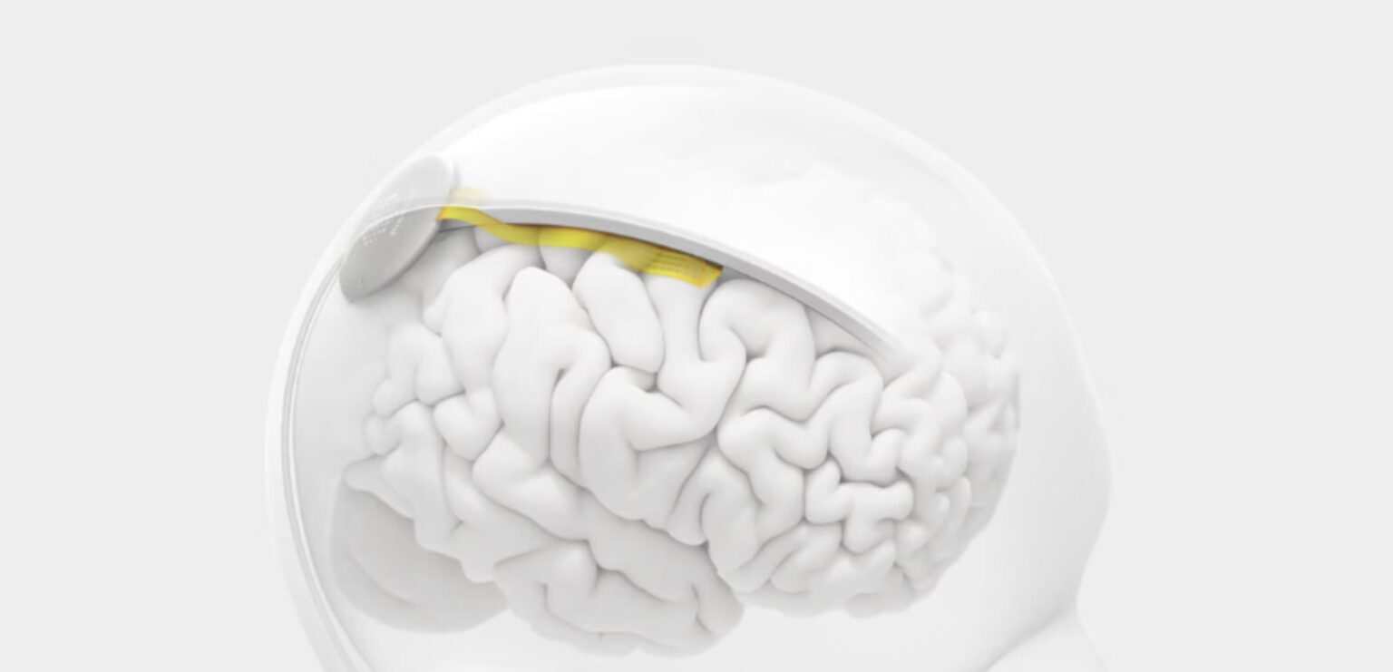 The Next Wave of Brain-Computer Interfaces (BCIs) - MedicalExpo e-Magazine